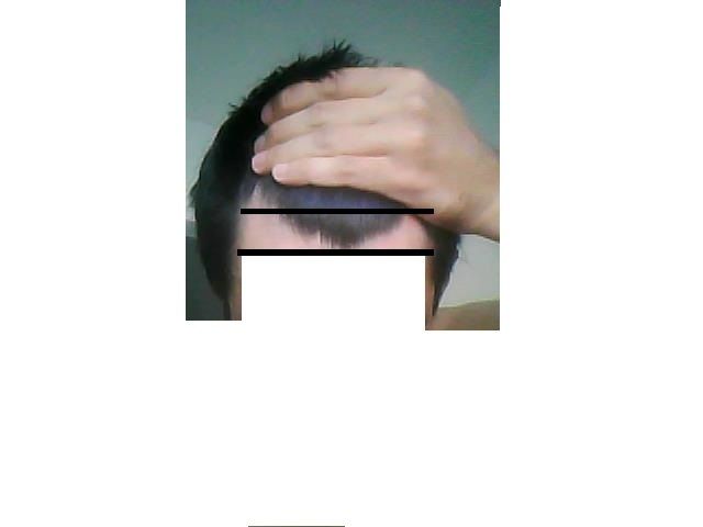 Am I receding (pics) : r/tressless